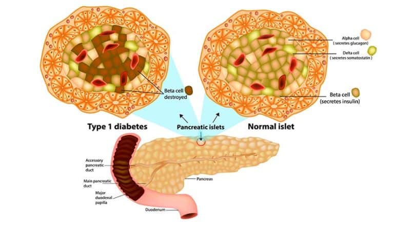Can You Regenerate Beta Cells Naturally for Type 1 Diabetes?